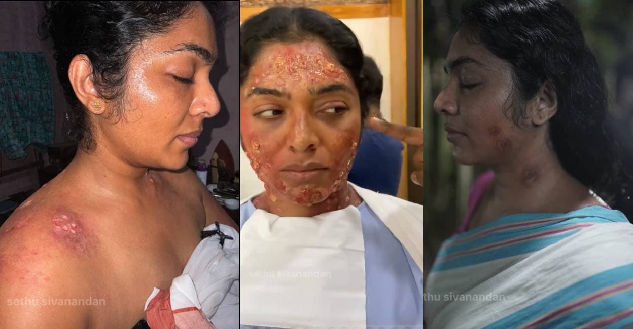 പ്രാണി കടിച്ച ‘റിമ’യ്ക്ക് സംഭവിച്ചത്; പ്രോസ്തറ്റിക് മേക്കപ്പ് ...