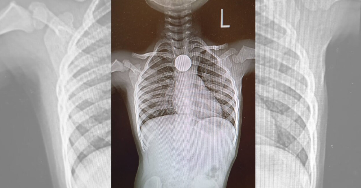 രണ്ട് വയസുകാരൻ അബദ്ധത്തിൽ വിഴുങ്ങിയ നാണയം പുറത്തെടുത്തു | toddler ...