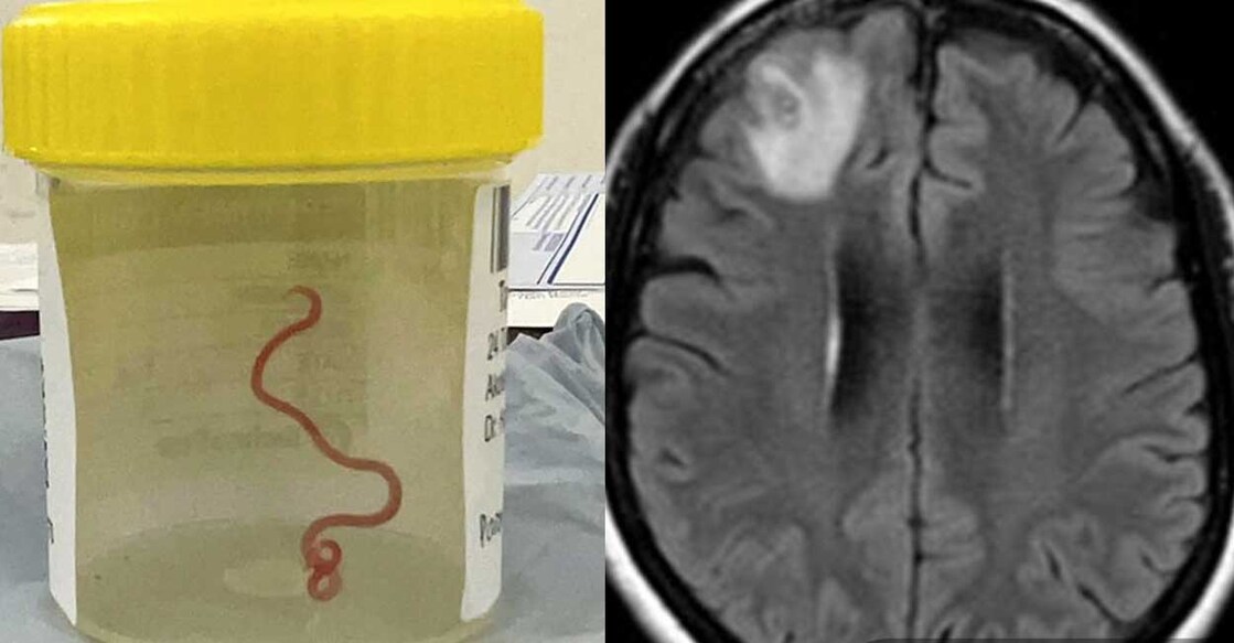 പാമ്പുകളിൽ കാണുന്ന വിര മനുഷ്യ മസ്തിഷ്കത്തിൽ ജീവനോടെ; 8 സെന്റിമീറ്റ ...