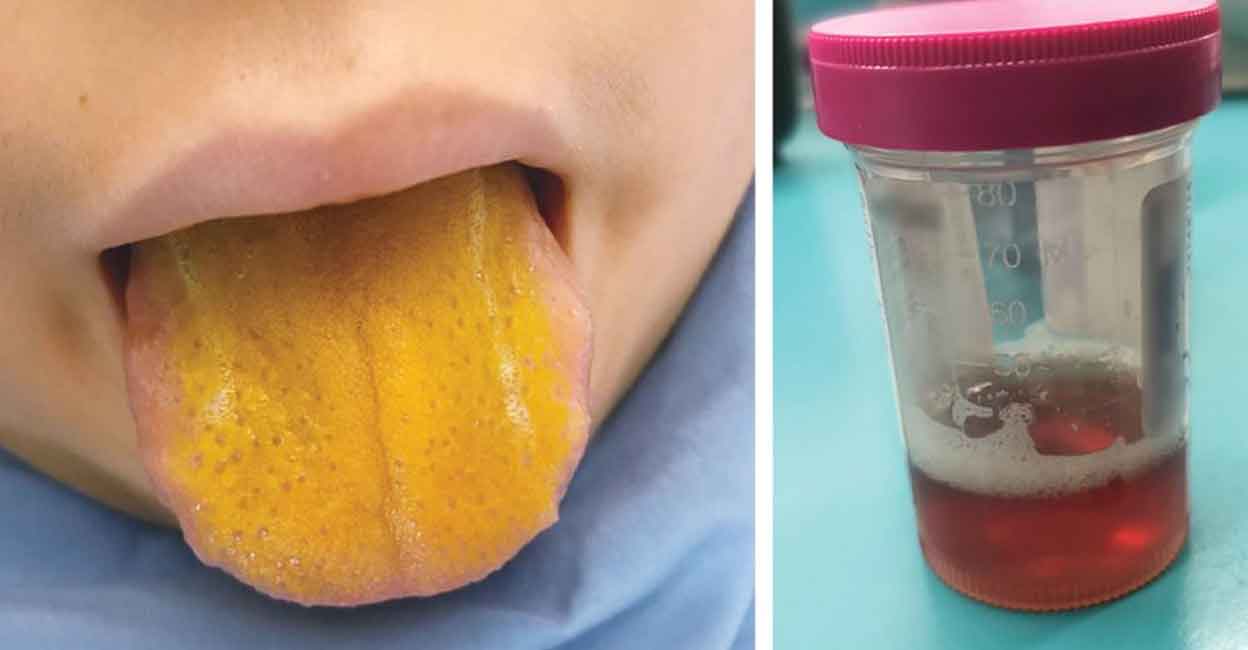 മഞ്ഞ നിറത്തിൽ നാവ്; പന്ത്രണ്ടുകാരനെ ബാധിച്ചത് അപൂർവ രോഗം | Rare disease