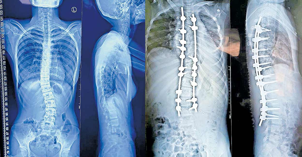 പ്രണവിന് ഇനി നിവർന്നു നിൽക്കാം 13 വയസ്സുകാരന്റെ നട്ടെല്ലിന്റെ വളവ് നിവ ...