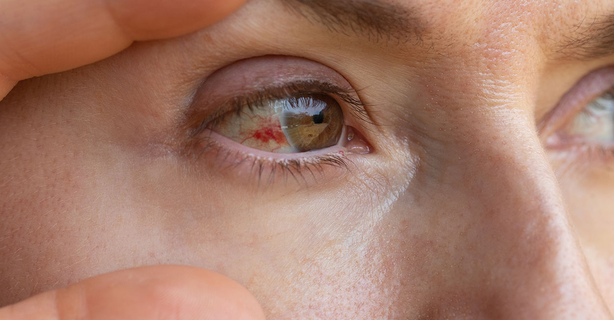 ഹൃദയാഘാതത്തിന്‍റെ ഈ ലക്ഷണങ്ങള്‍ നിങ്ങളുടെ കണ്ണില്‍ പ്രത്യക്ഷമാകാം ...