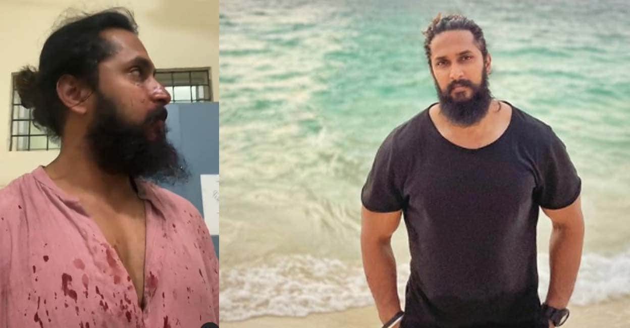 നടൻ ചേതനു നേരെ ആൾ‍ക്കൂട്ട ആക്രമണം; മൂക്ക് തകർന്ന അവസ്ഥയിൽ വിഡിയോ ...