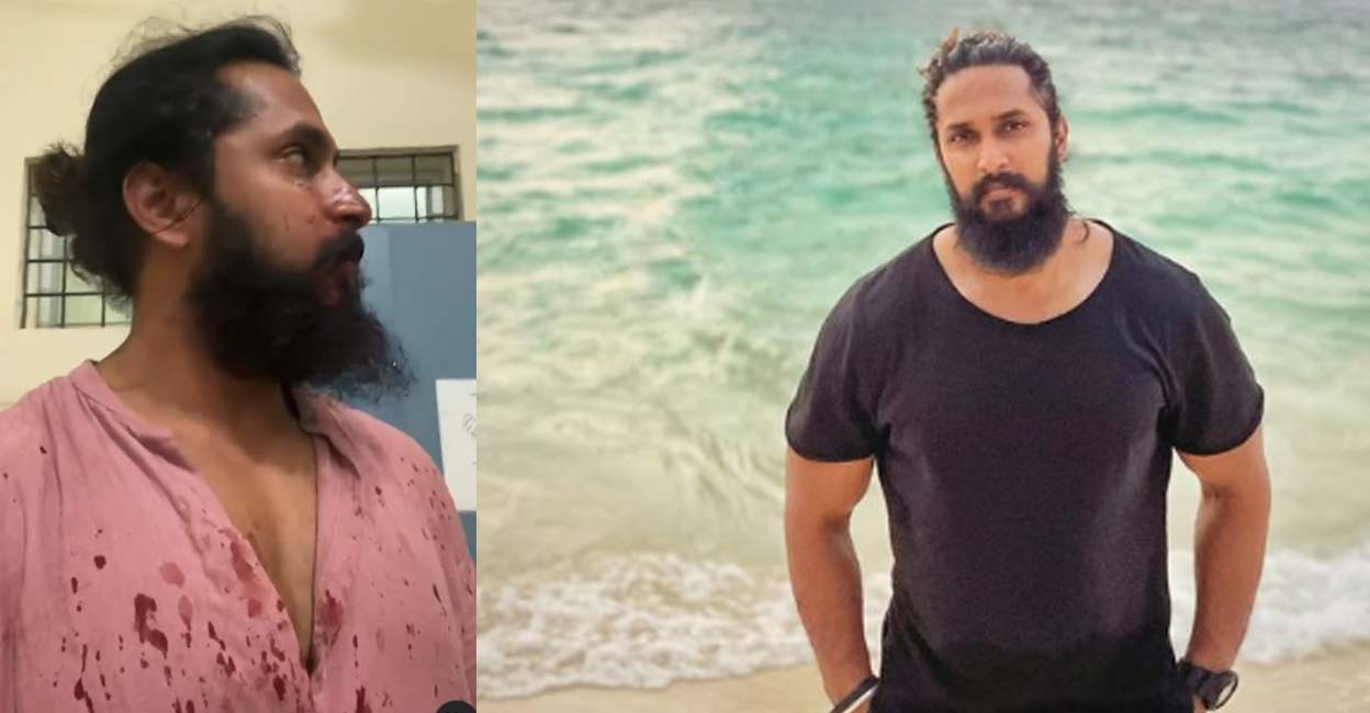 നടൻ ചേതനു നേരെ ആൾ‍ക്കൂട്ട ആക്രമണം; മൂക്ക് തകർന്ന അവസ്ഥയിൽ വിഡിയോ ...