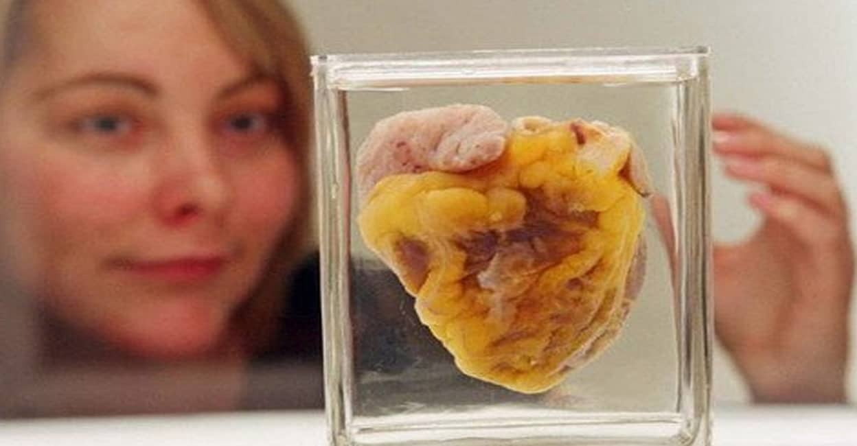 മ്യൂസിയത്തിലുള്ള സ്വന്തം ഹൃദയം കണ്ട് ജെന്നിഫർ– Woman Sees Her Own Heart ...