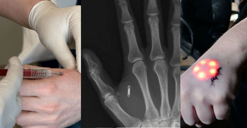 ശരീരത്തില്‍ ചിപ് അണിയാന്‍ ഭയമുണ്ടോ? ആ തീരുമാനത്തിലേക്കുള്ള നാളുകള് ...